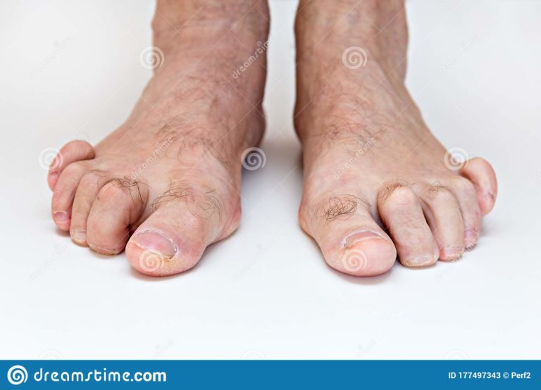 Quelle est la cause de l'orteil en marteau ? - Audition Audio France